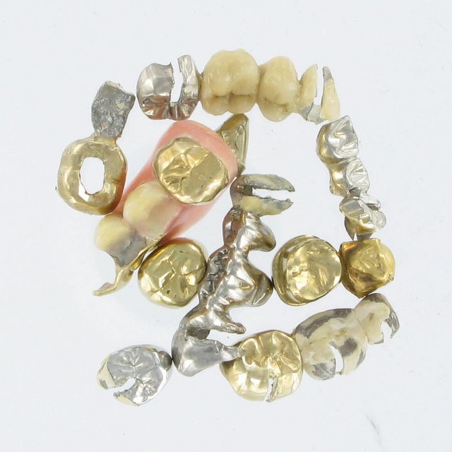 Pressetext - Pressebilder Zahngold / Dentalgold / Goldkronen | ESG